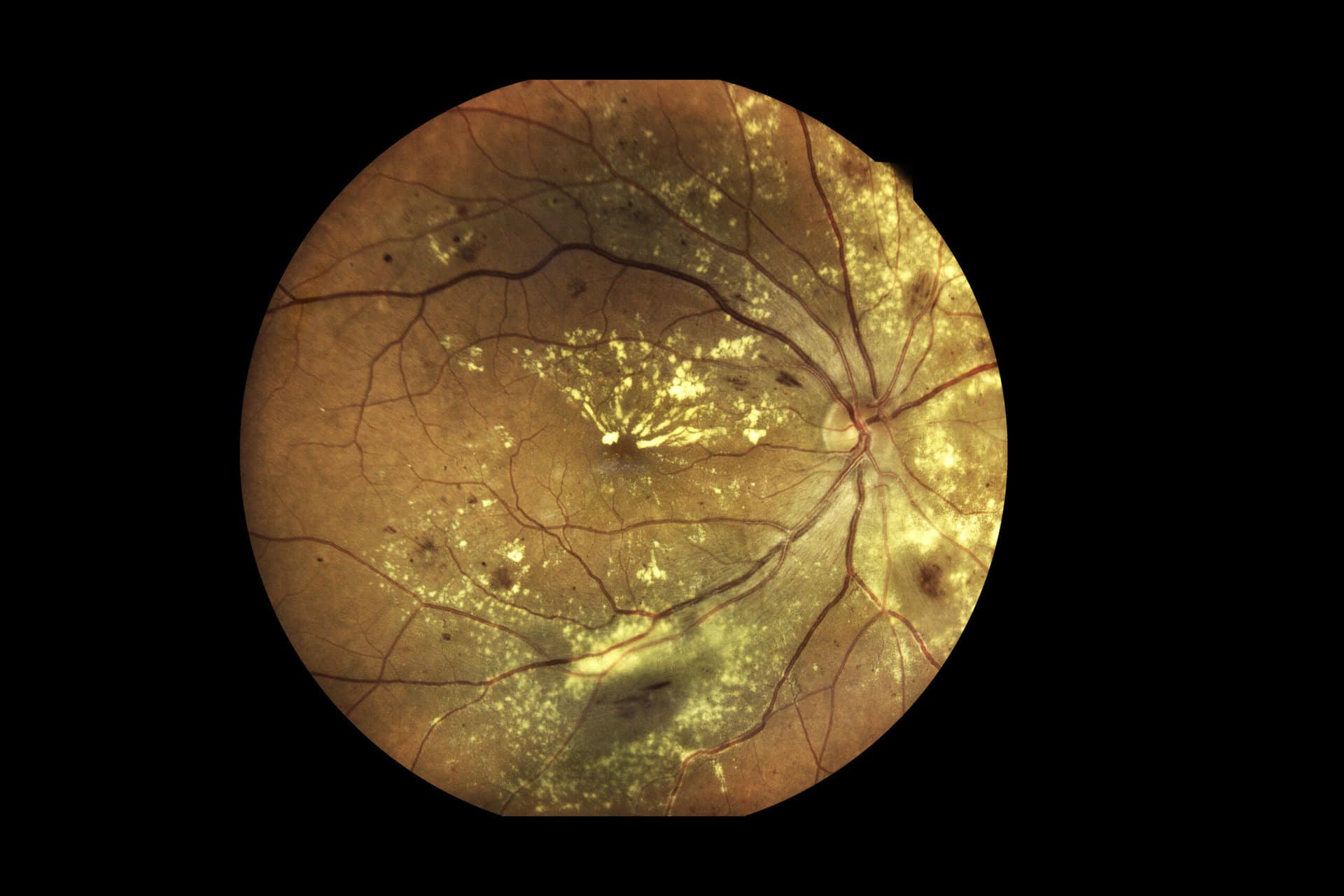 Age-Related Macular Degeneration Symptoms and Treatment - Clinique ...