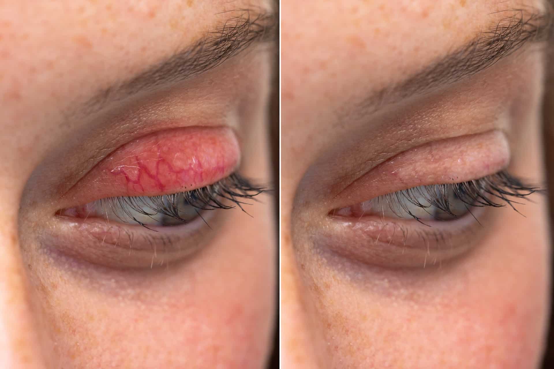 Blepharitis Symptoms and Treatment - Clinique VisionPros