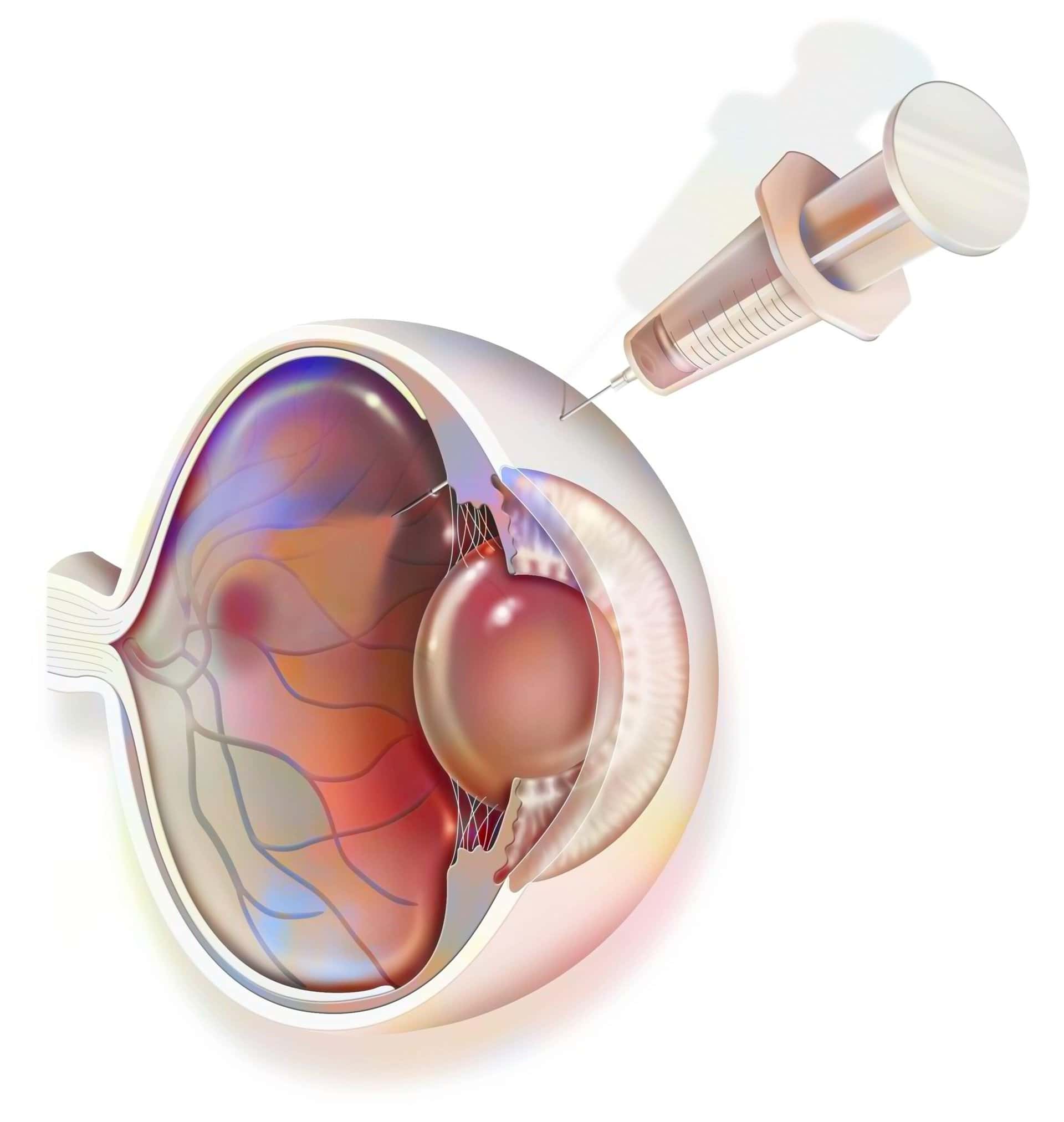 Diabetic Retinopathy Symptoms and Treatment - Clinique VisionPros