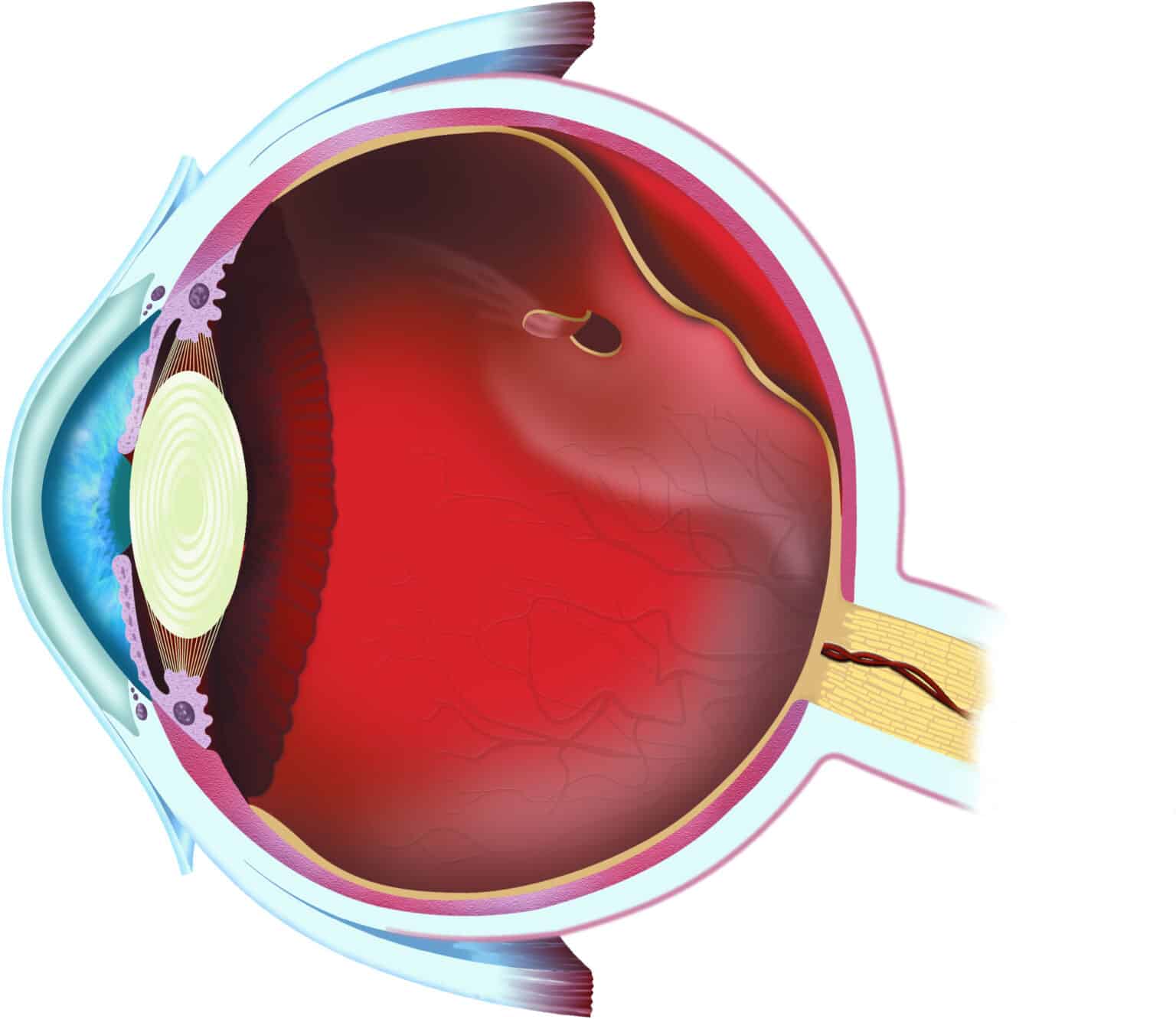Retinal Tears & Retinal Detachment Symptoms and Treatment - Clinique ...