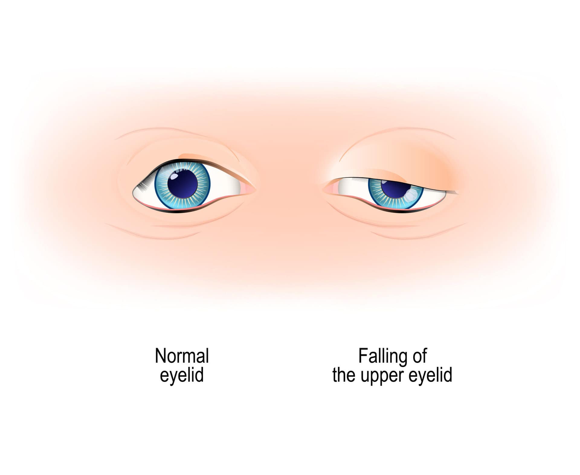 Eyelid Ptosis Symptoms and Treatment - Clinique VisionPros