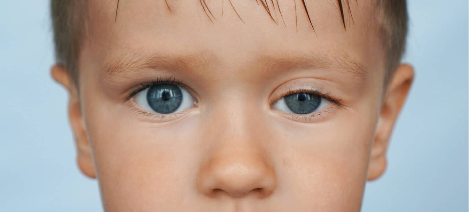 Eyelid Ptosis Symptoms and Treatment - Clinique VisionPros