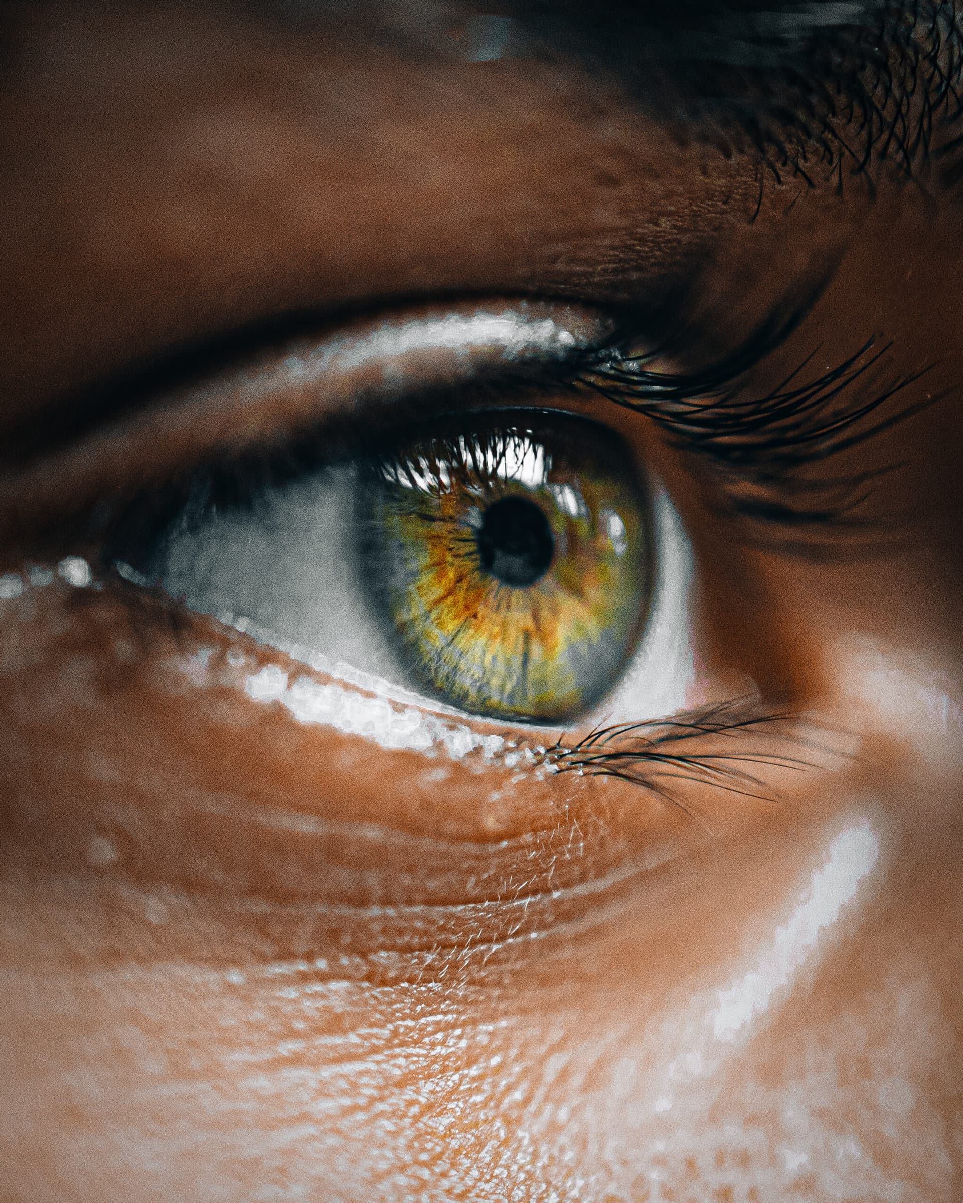 IPL for Dry Eyes: Get Long-Lasting Relief in Montreal | VisionPros